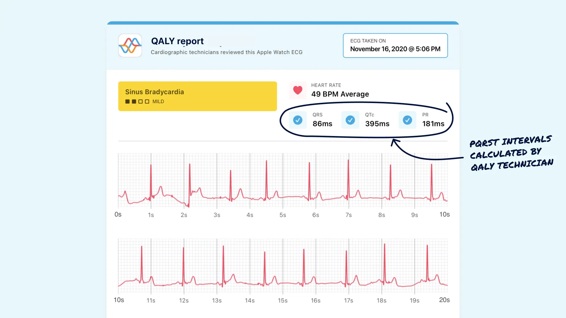 Qrs Interval On Your Watch Ecg Narrow Normal And Wide Qaly